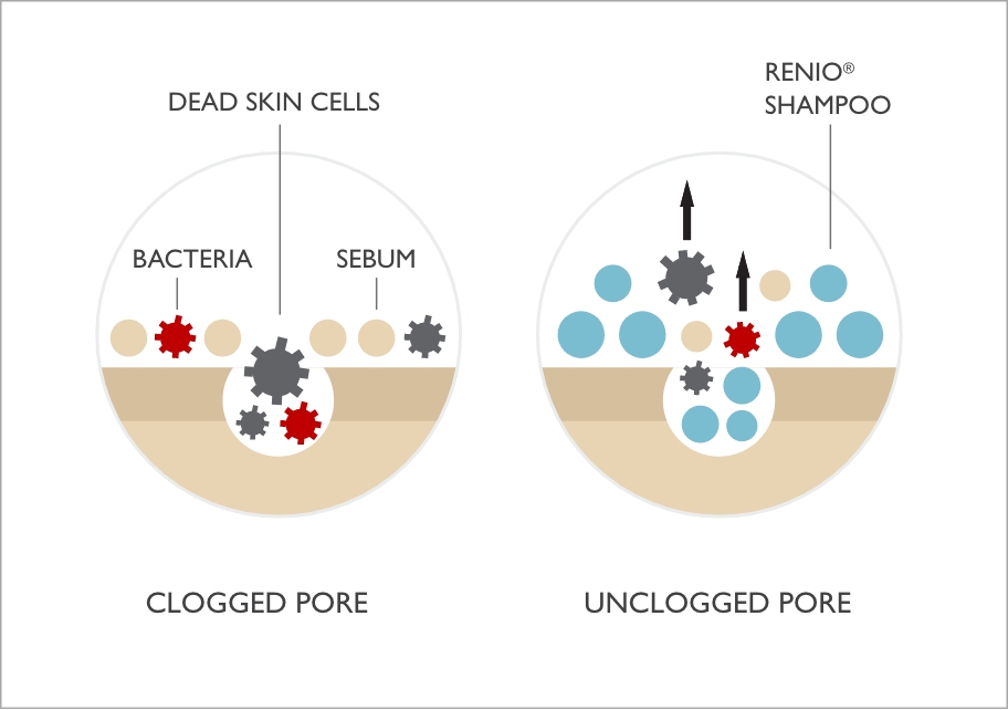 Renio Shampoo แชมพูผสมเซรั่มปลูกผม กระตุ้นผมขึ้นใหม่ หยุดผมร่วง